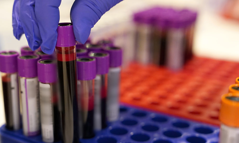 Des chercheurs trouvent des traces de Covid long dans le sang | LFM la ...